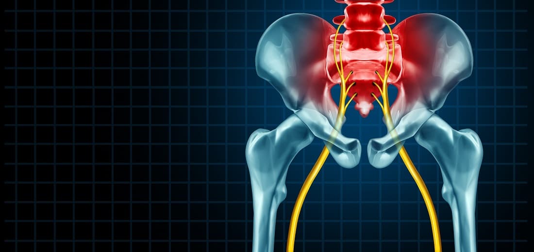 Sciatica - MidSouth Pain Treatment Center